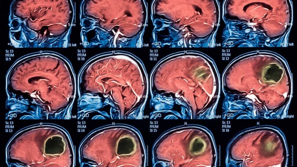 Surgical Management of Meningitis: Procedures, Treatment & FAQs